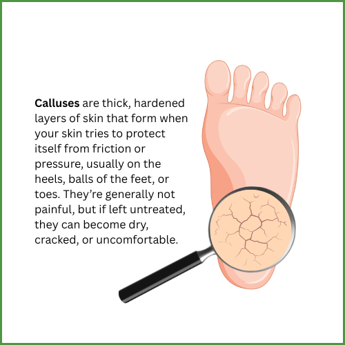 Calluses – Orthopedic Balance